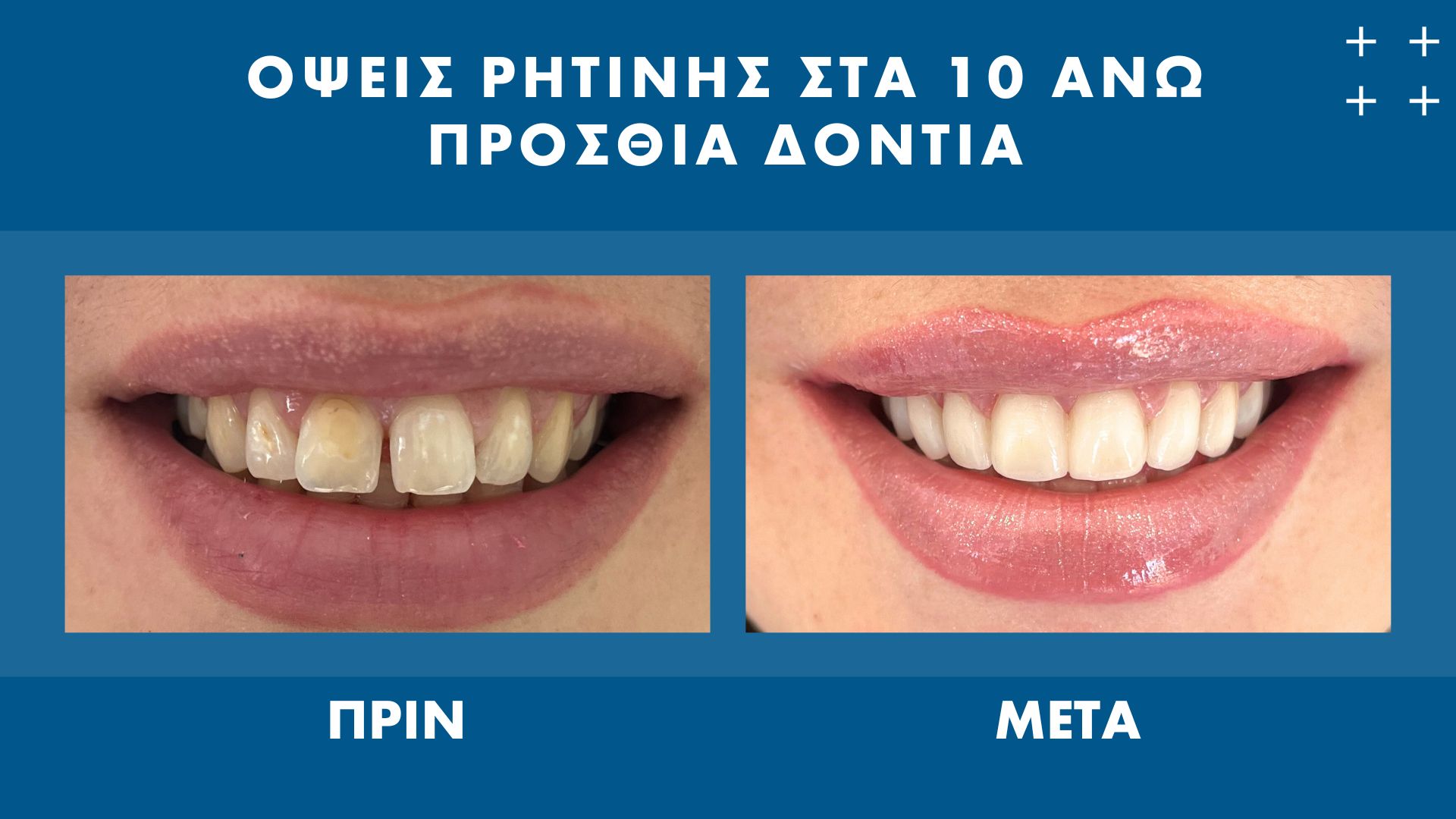 Όψεις Ρητίνης Κόστος - Διαδικασία Πριν & Μετά - ADP