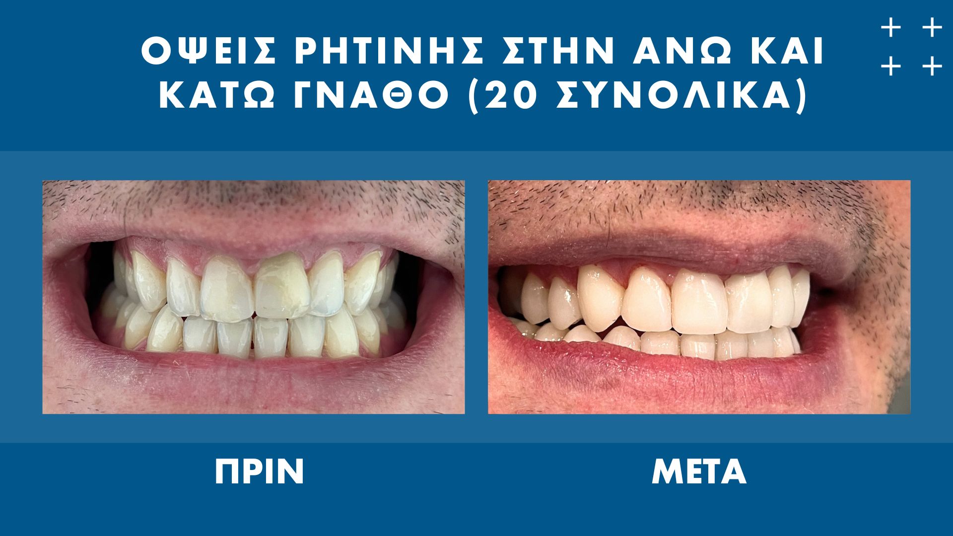Όψεις Ρητίνης Κόστος - Διαδικασία Πριν & Μετά - ADP