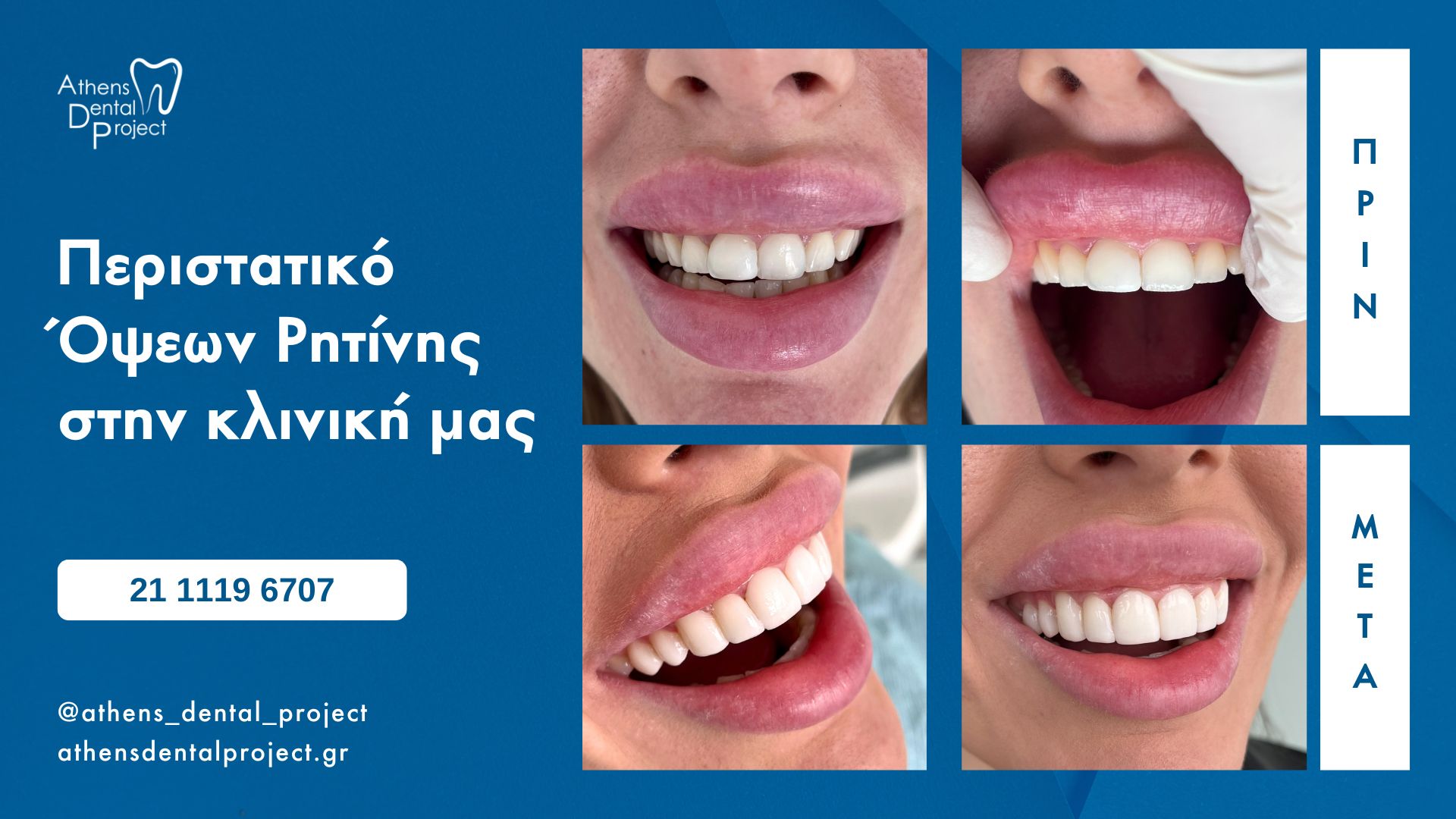 Όψεις Ρητίνης Κόστος - Διαδικασία Πριν & Μετά - ADP